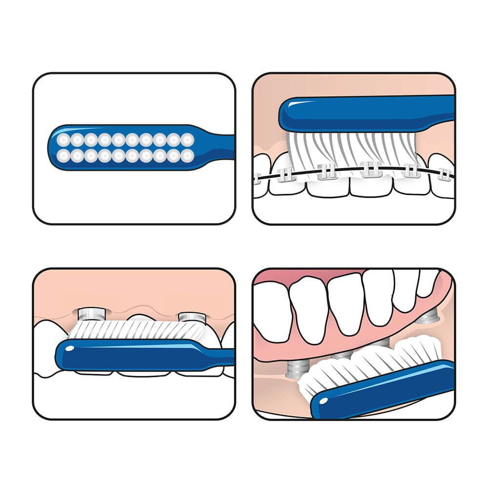 TePe Implant Orthodontic Brush™ | Soft and Extra Slim Toothbrush Head
